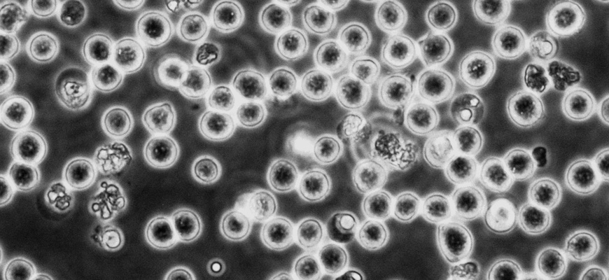 Neue Erkenntnisse zur ALL-Therapie - Frankfurter Stiftung für ...